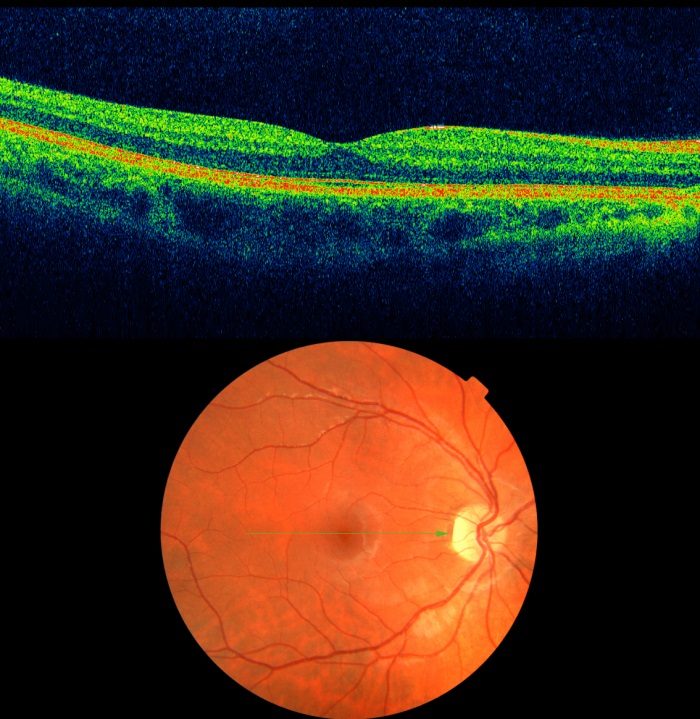 OCT - Stockholms Ögonklinik